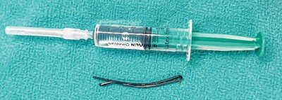Shija Hospital successfully removes hairpin from two and half year old ...